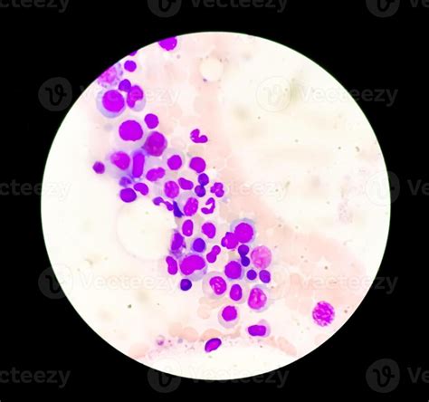 Photomicrograph Bone Marrow Study Megakaryocytic Hyperplasia 43292040