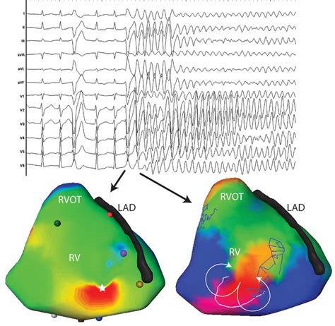 Twelve Lead Ecg And Activation Maps Of The First And Second Beats Of Download Scientific