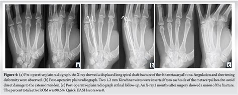 Clinical Outcomes Of Retrograde Percutaneous Pinning For Shaft Fracture Of Metacarpal Bone A