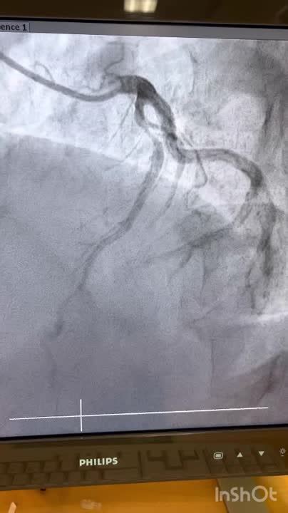 Lad Diagonal Bifurcation Minicrush Technique In Middle Of Case We Saw… Saeed Amiripouya