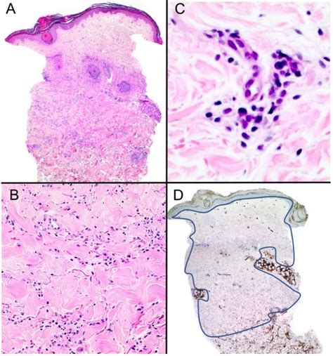 Loss Of Cd34 Expression Within An Interstitial Dermal Lymphoid Cell