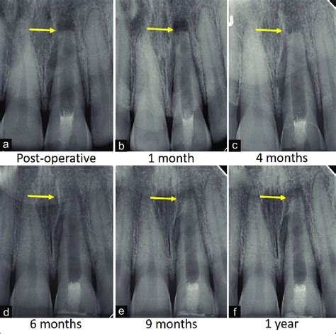A Series Of Follow Ups On Tooth 21 After The Revascularization Download Scientific Diagram
