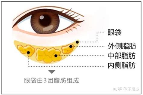 为什么医生不愿意把你的眼袋脂肪再多去点 知乎
