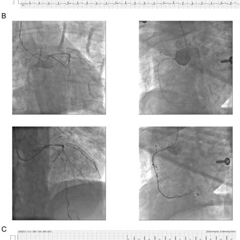 A Preoperative Electrocardiogram Ecg Suggested Acute Myocardial