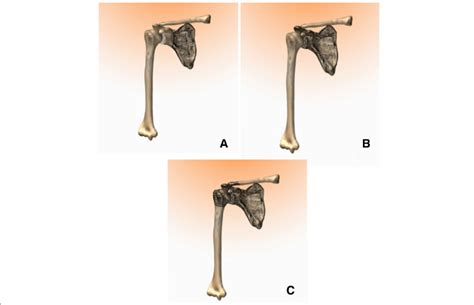Resections Of The Scapula A Type I Partial Scapular Resection With Download Scientific