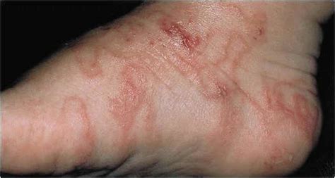 Hookworm Facts Life Cycle Picture Treatment