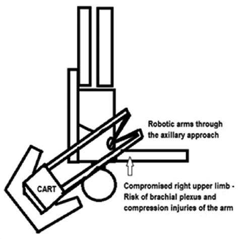 Subxiphoid Approach In Robotic Thymectomy Download Scientific Diagram