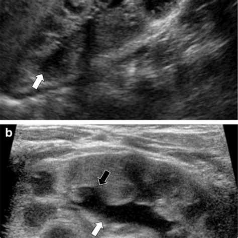 History Of Antenatal Urinary Tract Dilation In A 10 Day Old Girl A B