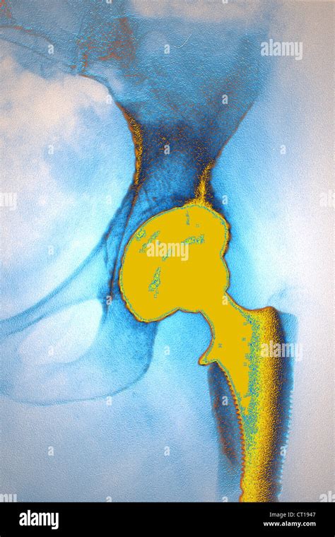 Hip Prosthesis X Ray Stock Photo Alamy