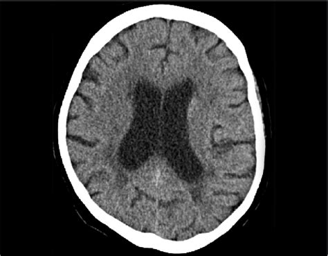 Brain Computed Tomography Download Scientific Diagram