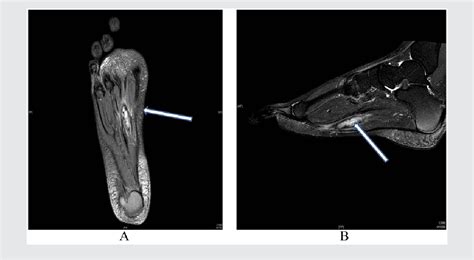 Figure 4 From Claw Toe Deformity Of The Foot Due To Foreign Body