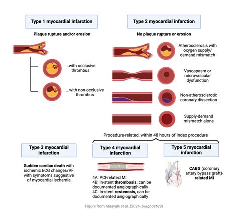 Mi Types 1 2 3 4 5 Troponin Toolbox