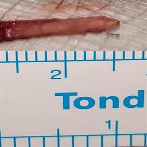 Left Side 16 Mm Of Theelongated Styloid Process Download