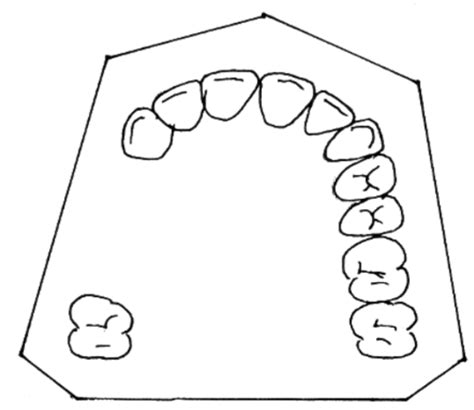 Partial Denture Outline 1 Flashcards Quizlet
