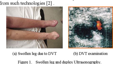 figure 1 from constructing binary decision trees for predicting deep venous thrombosis