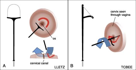 Large Loop Excision Of The Transformation Zone Versus True C Journal Of Lower Genital Tract