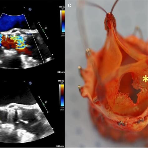 Case 1 Transesophageal Echocardiography Three Chamber View With
