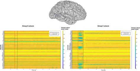 Stereotactic Eeg Electrodes Implantation Of One Subject Having One Stereotactic Eeg Electrodes Implantation Of One Subject Having One