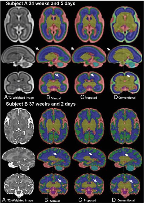 figure 1 from automated 3d fetal brain segmentation using an optimized