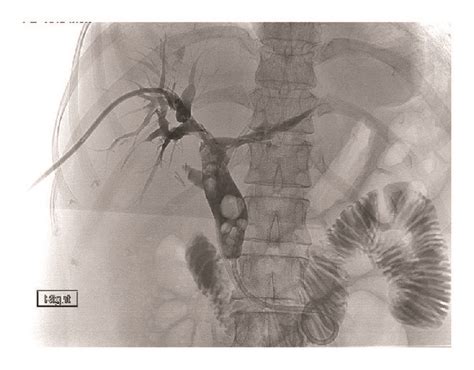 Percutaneous Cholangiogram Showing Multiple Stones In Biliary Tree