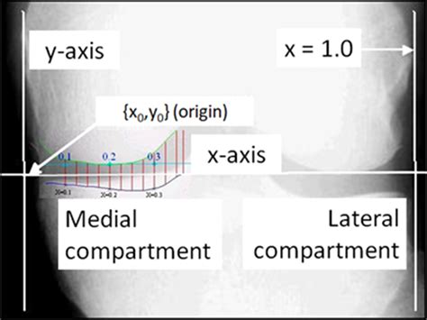 Validation Of Joint Space Narrowing On Plain Radiographs And Its