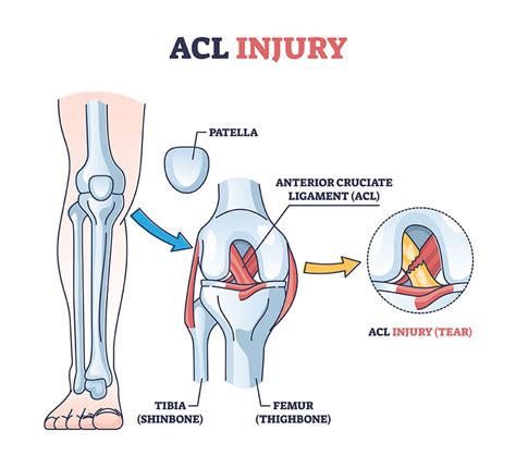 Acl Timelines How Lach Works With His Clients To Return To Sport