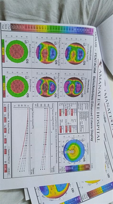 Ask A Eye Specialist Online For Corneal Topography