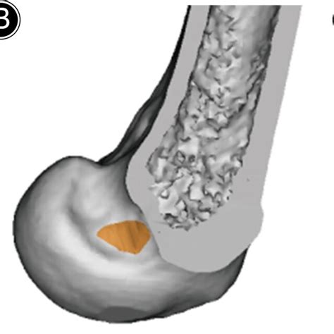 A The Diagram Of 3d Ct‐mri Fusion Model The Tibia Femur Pcl