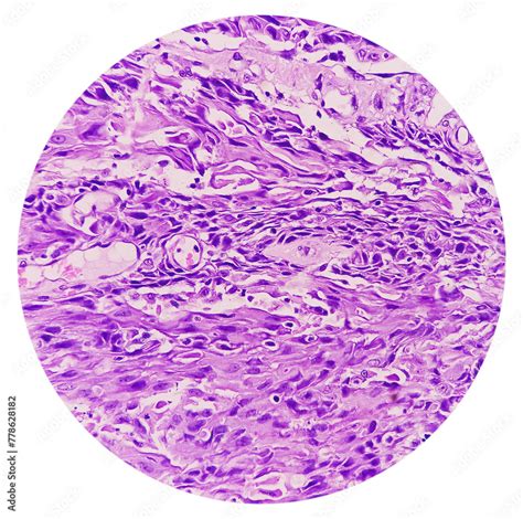 Photomicrograph Of Rectal Cancer Ibd Ibs Squamous Cell Carcinoma Of