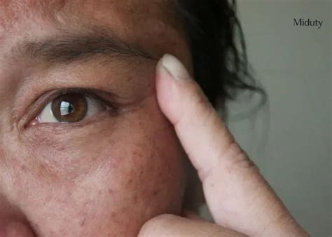 Post Inflammatory Hyperpigmentation Causes And Cure Miduty