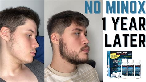 1 Year After Stopping Minoxidil Have I Lost Gains Youtube