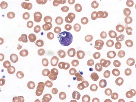 Cryptococcus In Peripheral Blood Smear Stock Image Image Of Cryptococcosis Microscope