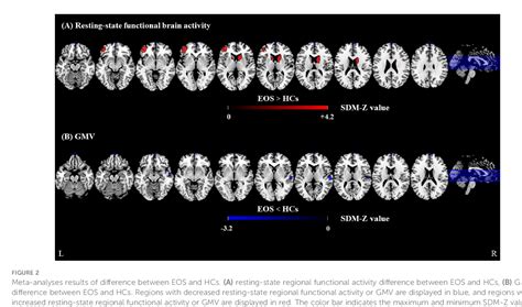 Figure 2 From Meta Analysis Of Structural And Functional Brain Abnormalities In Early Onset