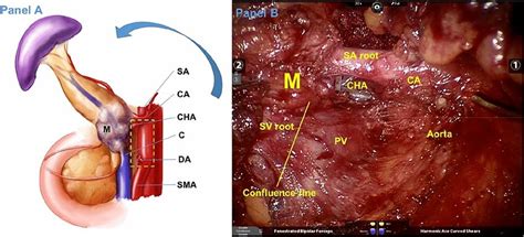 Post Pancreatic Anatomical View After Mobilization Of The Distal
