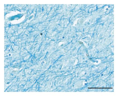 Myelin Staining In The Representative Ad Pd And Age Matched Cognitive