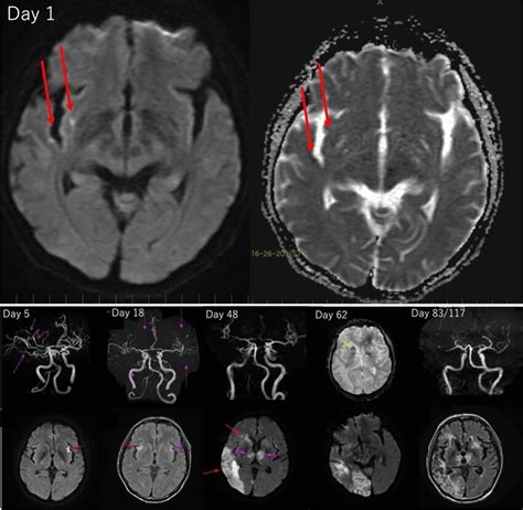 The Comparative Findings Of The Brain Mri The Dwi Revealed A High Download Scientific Diagram
