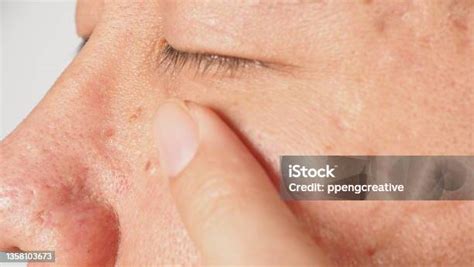 Verruga En La Cara Foto Macro De Verruga Cerca Del Ojo Papiloma En La