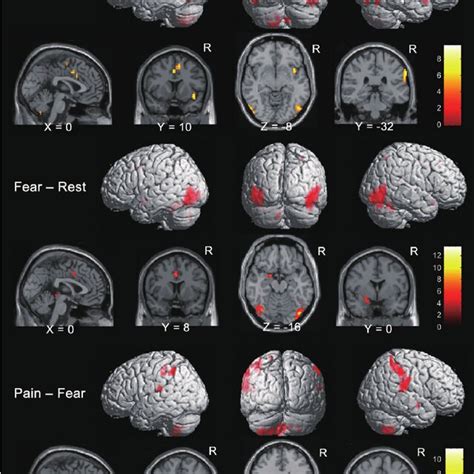 Brain Activations In Each Contrast Activated Brain Areas In Each Download Scientific Diagram