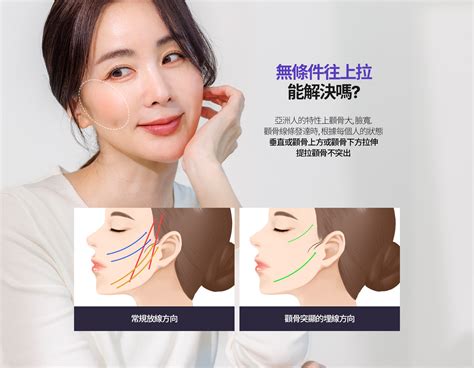 無條件往上拉 能解決嗎？ 亞洲人的特性上顴骨大，臉寬。顴骨線條發達時，根據每個人的狀態 垂直或顴骨上方或顴骨下方拉伸 提拉顴骨不突出 常規放線