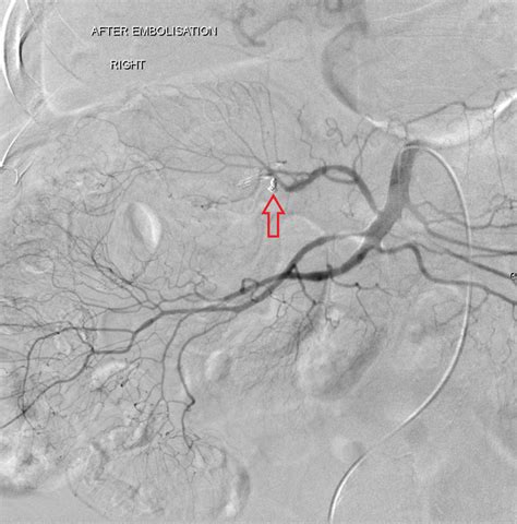 Post‐embolisation Of Bleed With The Use Of Micro‐coils No Evidence Of Download Scientific