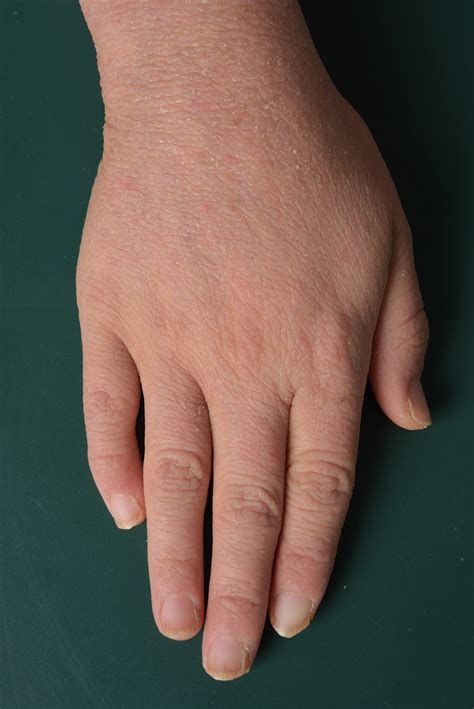 Acral Keratoderma And Sudden Death Diagnostic Histopathology