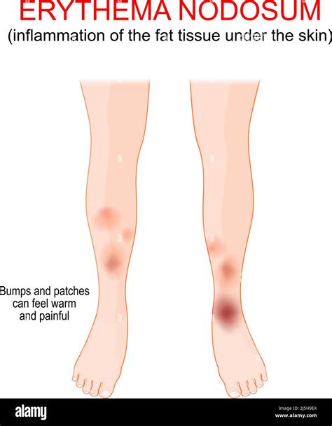 Erythema Skin Stock Vector Images Alamy