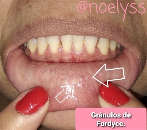 🤔 Fordyce Granules And How Can They Be Confused With Pathologies