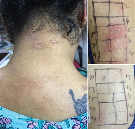 Patch Testing With Indian Standard Series Of 20 Allergens In 125 Patients Of Chronic Dermatitis