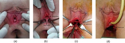 Treatment Of Urethral Intercourse And Impact On Female Sexual Function PMC