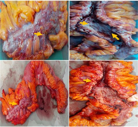 Specimen With Arrow Indicating Nodule Ulcerations And Parietal
