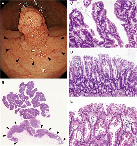 Superficially Serrated Adenoma A Proposal For A Novel Subtype Of
