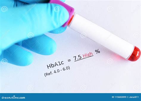 Abnormal High Hba1c Test Result Stock Image Image Of Diabetes Test 115602899