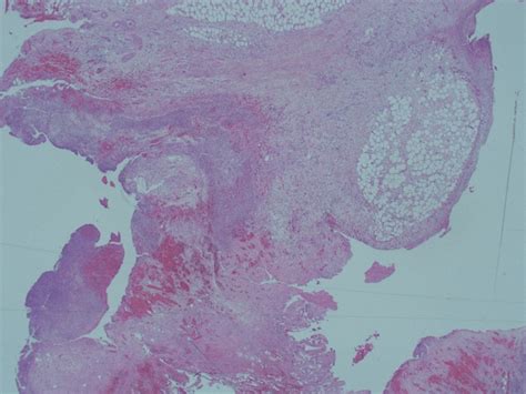 Diverticulitis And Diverticulosis Of The Appendix A Case Series Pmc