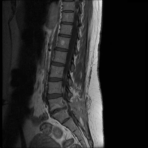 Spinal Epidural Abscess